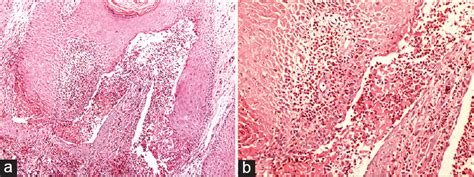 Pyostomatitis Vegetans Histology