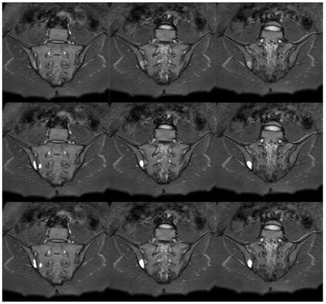 performance of fully automated algorithm detecting bone marrow edema in sacroiliac joints