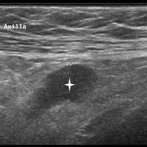 A Left Axillary Lymph Node Excision Revealed Metastatic Poorly Download Scientific Diagram