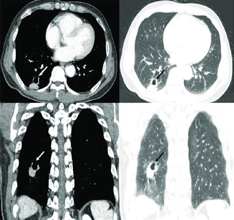 A D Initial Chest Ct On Health Screening Revealed A 32 Cm Cavitary