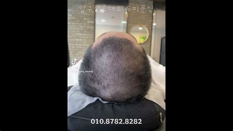 [정수리문신] 시술 교육 창업문의 정수리문신 Smp두피문신 두피문신 Hair 두피문신창업 Youtube