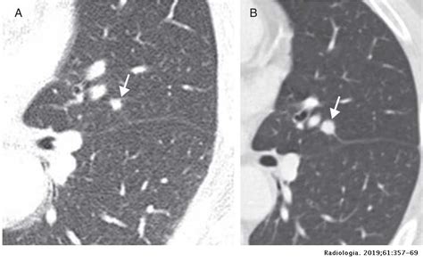 Nódulo Pulmonar Incidental Caracterización Y Manejo Radiología