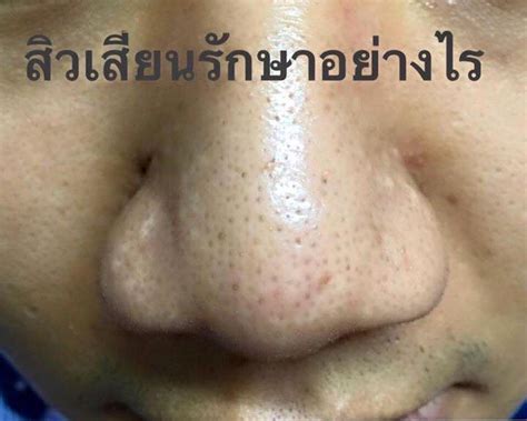 จุดดำๆที่จมูก หรือ สิวเสี้ยน Trichostasis Spinulosa รักษาได้ไหมครับ