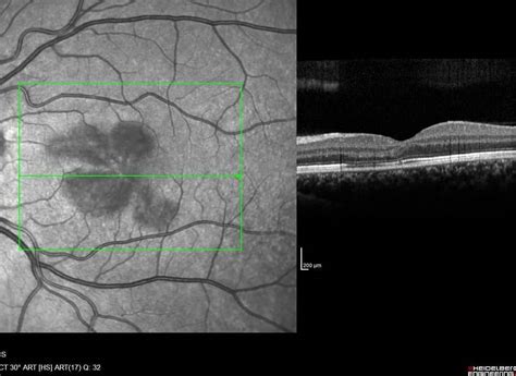 Paracentral Scotoma Outlook Eye Specialists