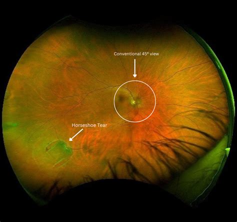Know How To Spot Eye Disease Symptoms The Optical Co