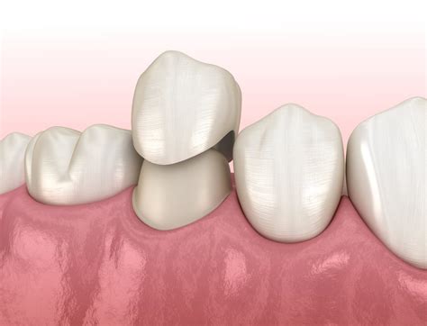 Do You Need A Root Canal Before A Crown Essential Tips
