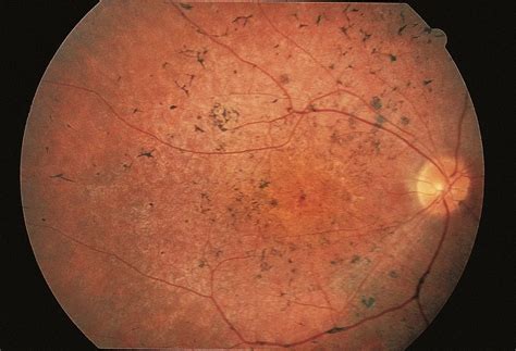 Cone Rod Dystrophy American Academy Of Ophthalmology