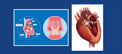 Tavr Tavi Ahmedabad Dr Subhash D Chaudhari