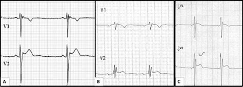Misplacement Of V1 And V2 • Litfl • Ecg Library Basics