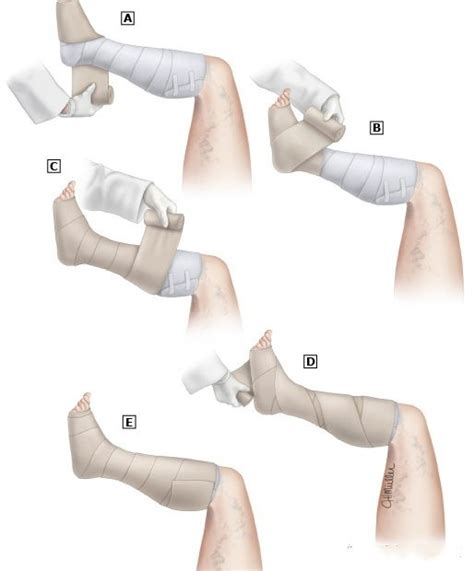 Compression Bandage Pressure Measurement At Tamara Hall Blog