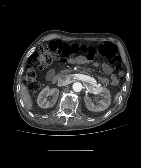 Renal Cell Carcinoma With Tumour Thrombus Eurorad