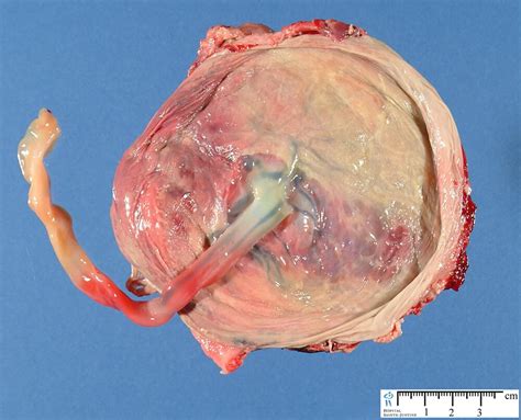 Acute Chorioamnionitis Human Pathology
