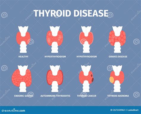 Thyroid Gland Various Diseases Goiter And Hyperthyroid Inflammation