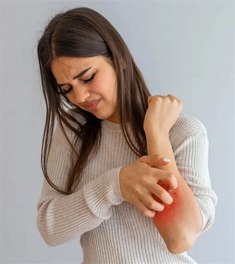 22 Home Remedies To Get Rid Of Rashes On The Face Diet And Prevention