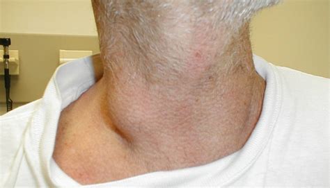 Lymphadenitis Symptoms Diagnosis Treatment And Prevention Of Infection