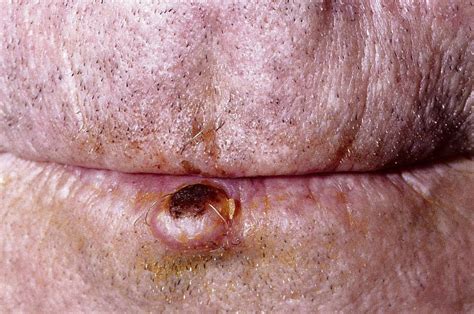 Basal Cell Carcinoma Vs Squamous Cell Carcinoma Usmle