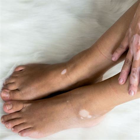 Vitiligo Causes Symptoms Types Vitiligo Treatment Usa