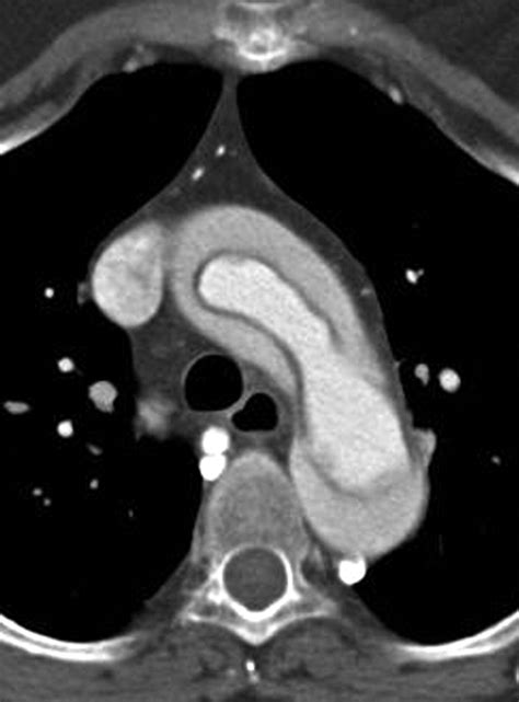 Aortic Dissection Ct Scan