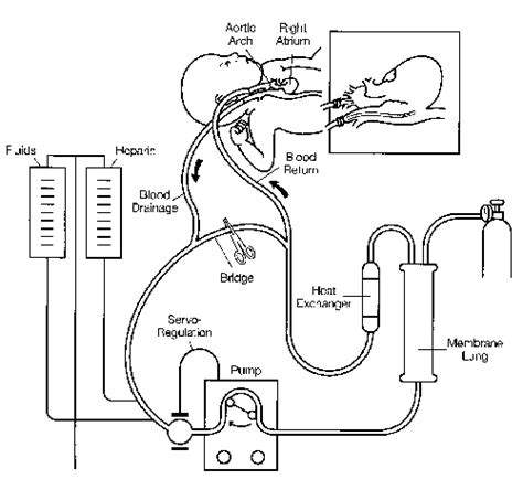 Diffusion Of Extracorporeal Membrane Oxygenation Ecmo Report Of The Workshop Nichd Eunice
