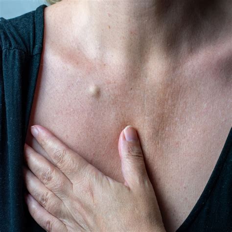 Kyste Sur Le Torse Comment Sen Débarasser Chirurgie Dermatologique Paris Monceau