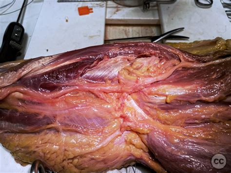 Distal Biceps Bicortical Endobutton Fixation