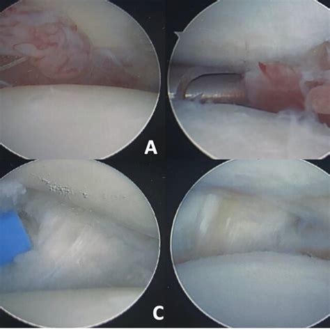 A Mcp Synovitis Arthroscopical View B Removing Synovitis With