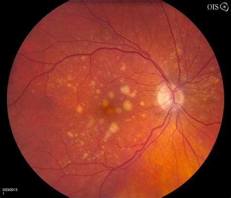 Macular Drusen Retina Image Bank