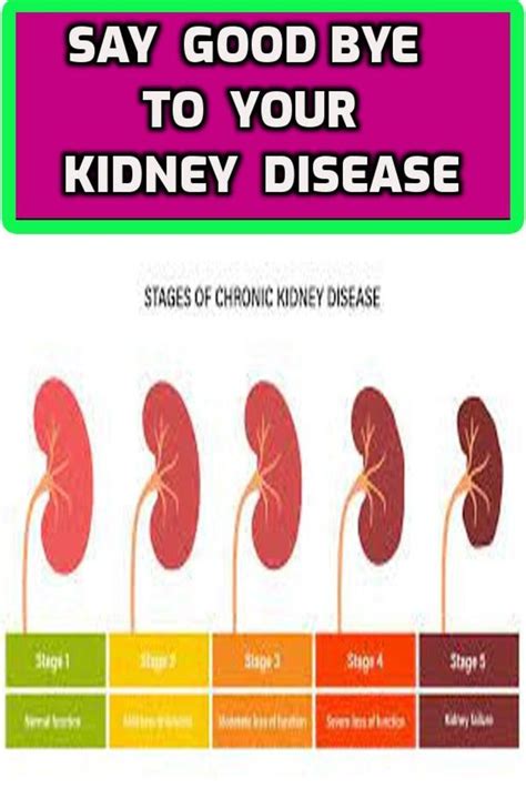 End Stage Renal Failure Artofit