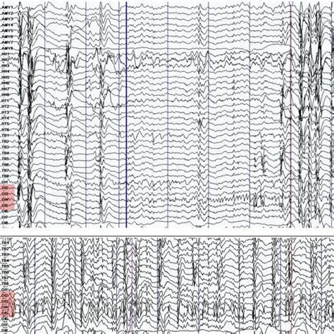 Case Example Seizure 2 Intracranial Eeg Recording Of Ictal Onset From
