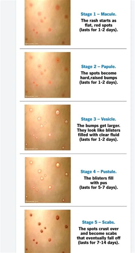 Soumyadeep Dutta On Linkedin Though No Cases Have Been Reported In India Yet However The