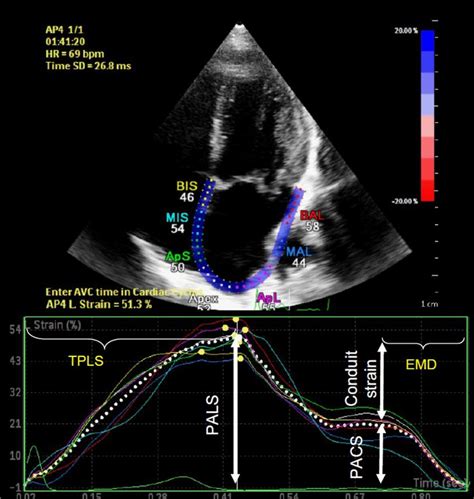 Strain Parameters Measured In Apical 4 Chamber View Pals Peak Atrial
