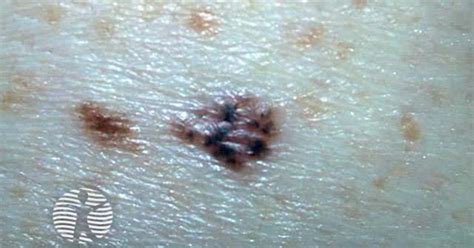 Basal Cell Carcinoma Image
