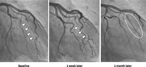 Spontaneous Coronary Artery Dissection Not Strictly A Benign Female