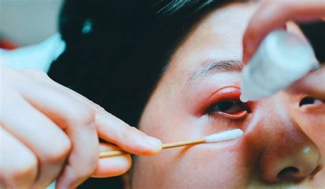 What Causes A Swollen Eyelid Prevention And Effective Treatments