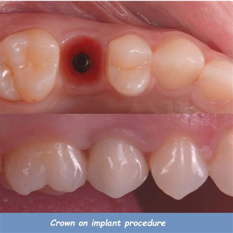 Crown On Implant Procedure Dental Specialist Clinic