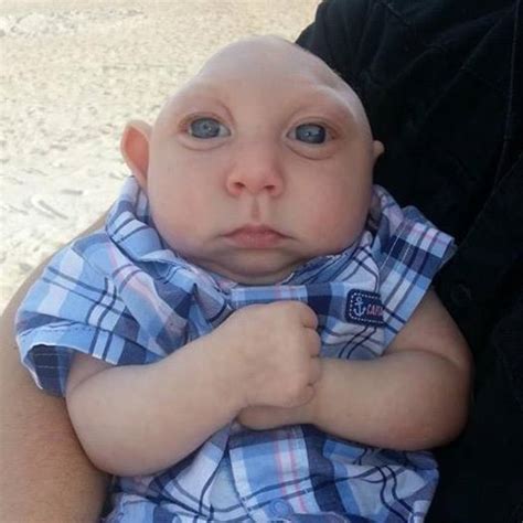 ¡milagro Niño Sobrevive Sin Parte Del Cerebro Y Cráneo Fotos
