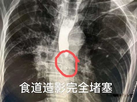 66岁食管癌患者无法吃饭喝水还能治好吗？食管支架—小小支架撑起生命通道 知乎