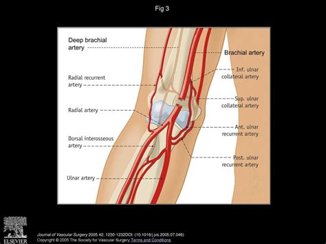 Transection Of The Brachial Artery After Closed Posterior Elbow
