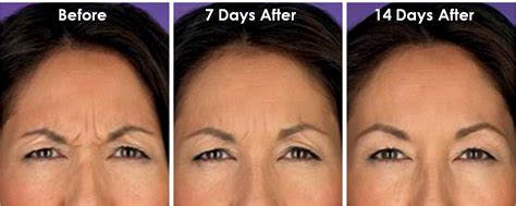How Long Did It Take Your Botox To Work At Bobbye Pederson Blog