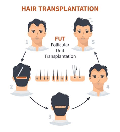 Premium Vector Stages Of Hair Transplantation Fut Follicular Unit