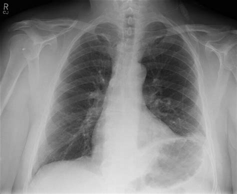 Radiopaedia Case Phrenic Nerve Palsy Secondary To Interscalene Brachial