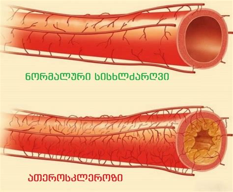 50 მლ ამ სასმლისა დღეში და თქვენი სისხლძარღვები გაიწმინდება ინსულტი ვეღარ შეგაშინებთ