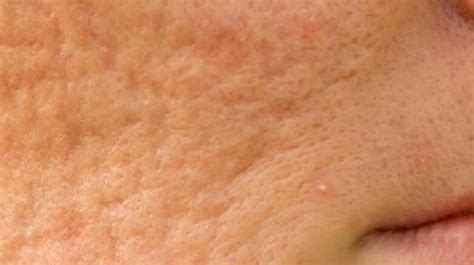 Derma Roller Solution For Acne Scar And Skin Imperfections