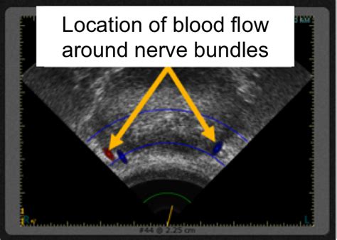 Feature In Focus Neurovascular Bundle Detection Software To Preserve