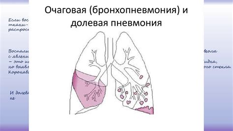 Пневмония Причины Симптомы и признаки диагностика лечение Youtube