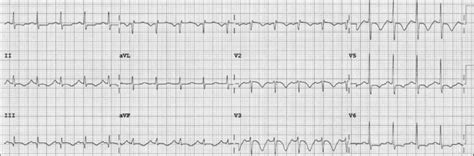 Pulmcrit Blogitorial Use Of Ecgs For Management Of Sub Massive Pe