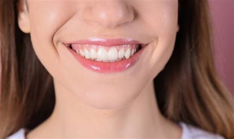 Extreme Gummy Smile