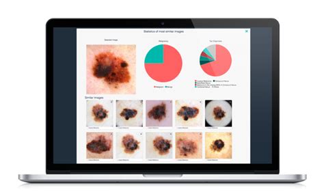 News MoleScope Smartphone Dermatoscope For Digital Dermoscopy