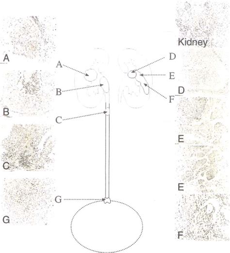 Topological Arrangement Of The Tumors And The Histology Of The Various