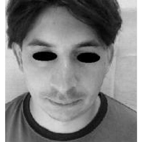 Preoperative Image Of Neoplastic Amputation Of Left Ear A The